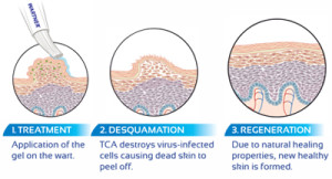 Wartner Verruca & Wart Removal Pen - Wartner.com